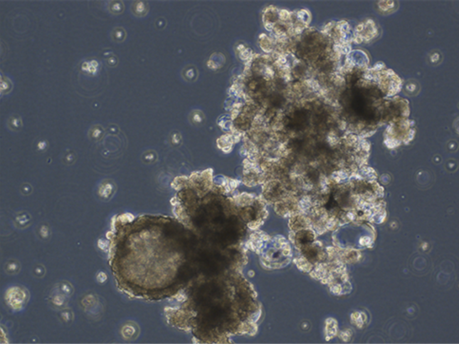 Ovarian cancer | CancerTools.org